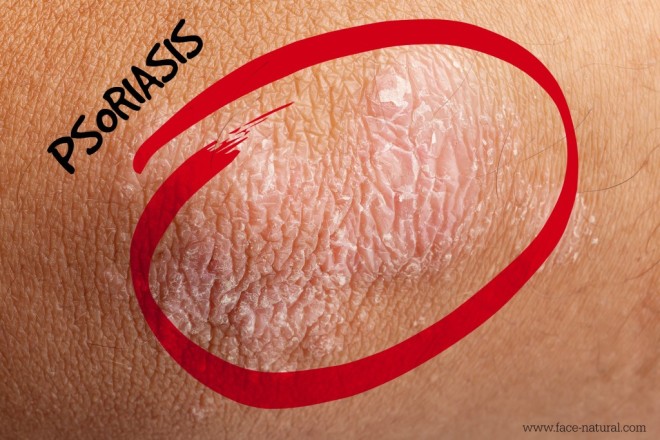 H-Psoriasis Formula Review - Wart Removal Treatments